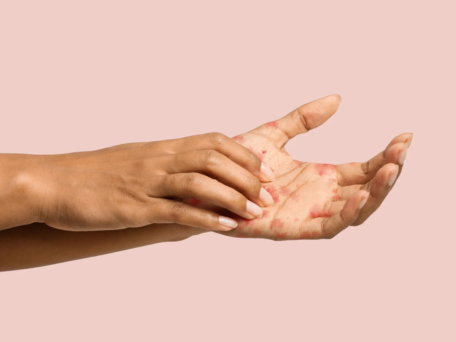 How To Finally Get Rid Of Hand Eczema 2024 Guide Icydk